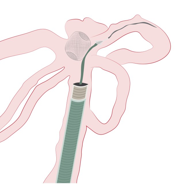 Solitaire Platinum Revascularization Device